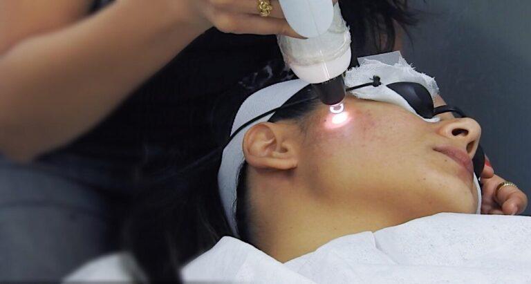 Q-switch Laser